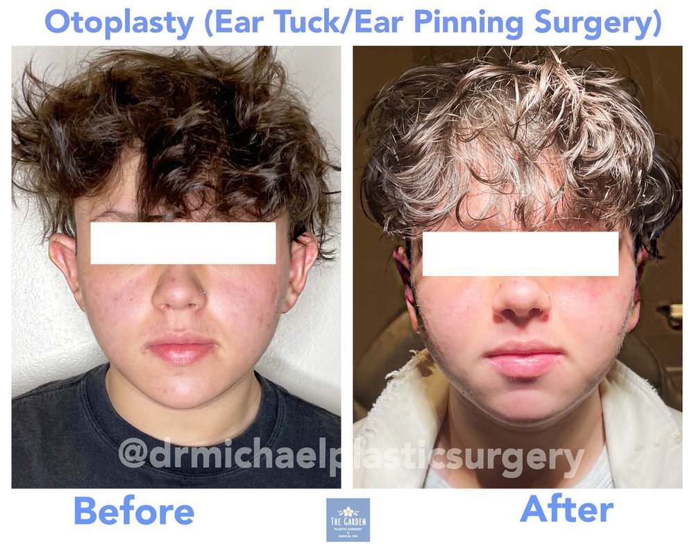 Ear Reshaping Otoplasty | The Garden Plastic Surgery